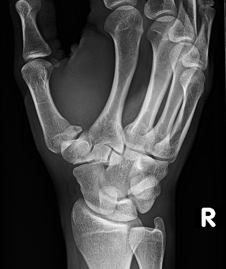 Image Quiz: Bennett Fracture