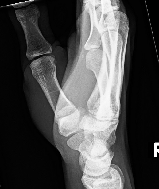 Image Quiz: Bennett Fracture