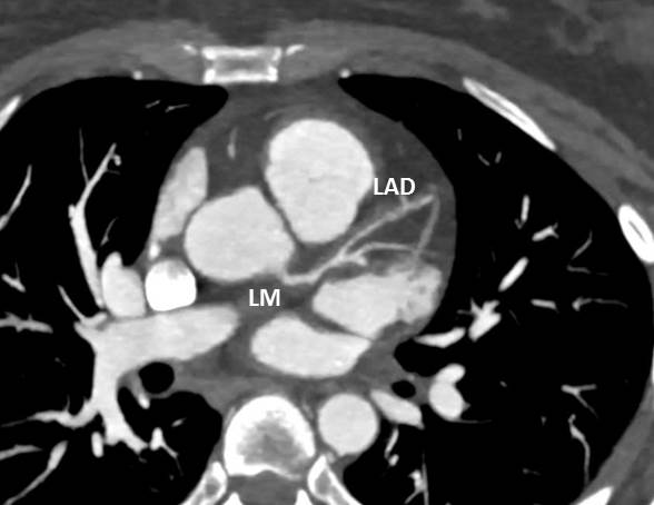 Spontaneous Coronary Artery Dissection - Society of Cardiovascular ...