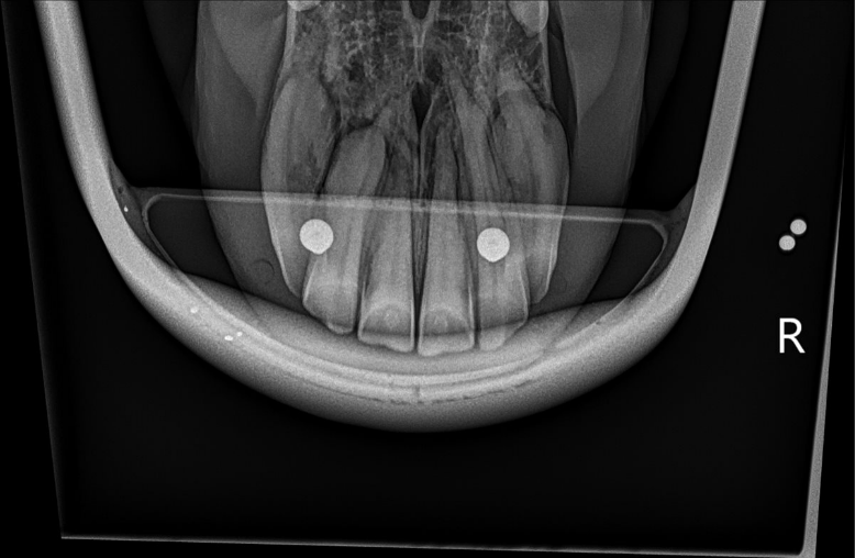X-ray of lower incisors in oral speculum exhibiting EOTRH